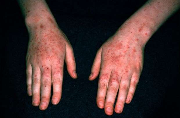 How to stop prickly heat - In2town Travel Magazine